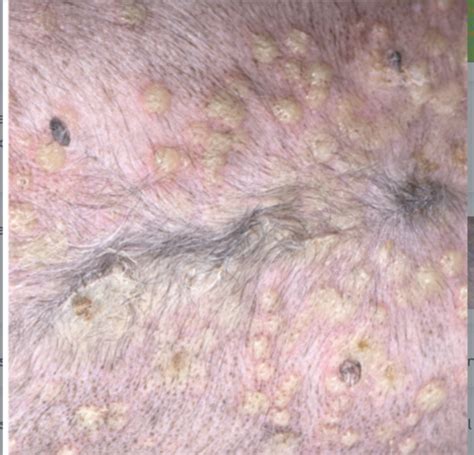 Pemphigus An Autoimmune Skin Condition Flashcards Quizlet