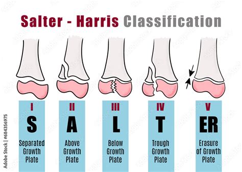 Poster Salter Harris Classification To To Recognize And Identify Different Types Of B Wall