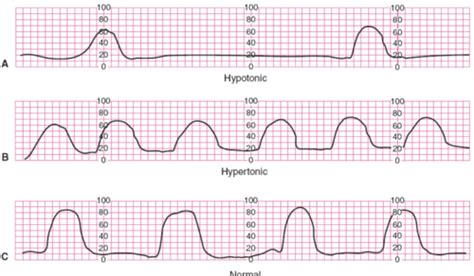 Ob Module 4 Nursing Care Of High Risk Labor And Pp Complications