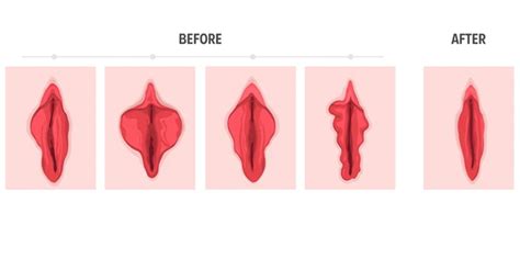 Vaginoplasty And Labiaplasty Dr Puguh