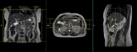 Mrcp Planning Mrcp Protocols Indications For Mri Cholangiopancreatography