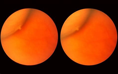 Peripheral Retinal Lesion Retina Image Bank