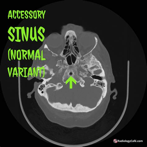 Radiology Cafe The Correct Answer Accessory Sinus