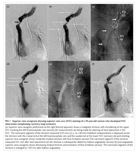 Endovascular Stenting In The Management Of Malignant Superior Vena Cava