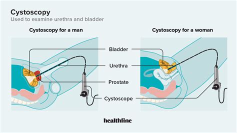 Cystoscopy For Bladder Cancer Procedure Risks Results