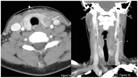 Thyroid Abscess As A Complication Of Bacterial Throat Infection Pmc
