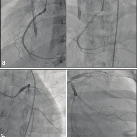 Right Coronary Angiogram A And Left Circumflex B Angiogram Showing