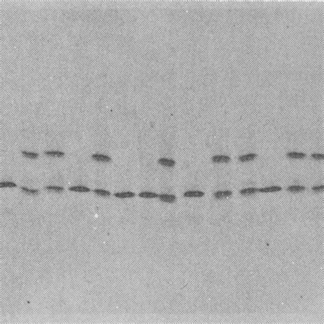 Typical Gel Pattern Of Sheep Hemoglobin Separated By Thin Layer