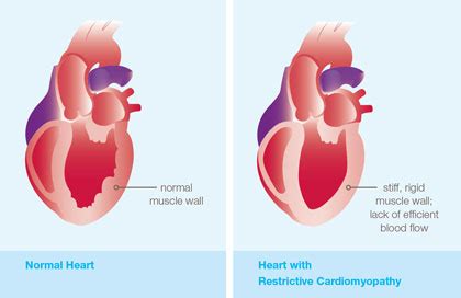 Restrictive Cardiomyopathy Rcm Pediatric Cardiomyopathy