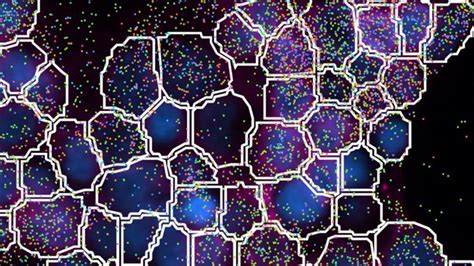 Spatialtranscriptomics Bioinformatics Cancerresearch