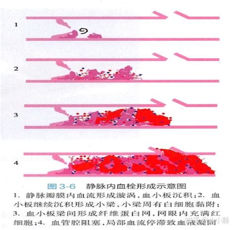 血管外科知识合集 病理学 知乎