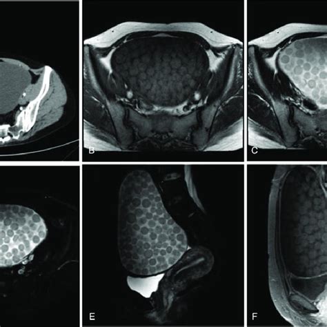 Pdf Mature Ovarian Cystic Teratoma With Sack Of Marbles” Appearance