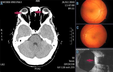 Sclerochoroidal Calcification Associated With Albrights Hereditary