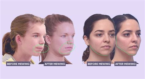 Mewing The Technique And Its Potential Impact On Facial Structure Qrjmn