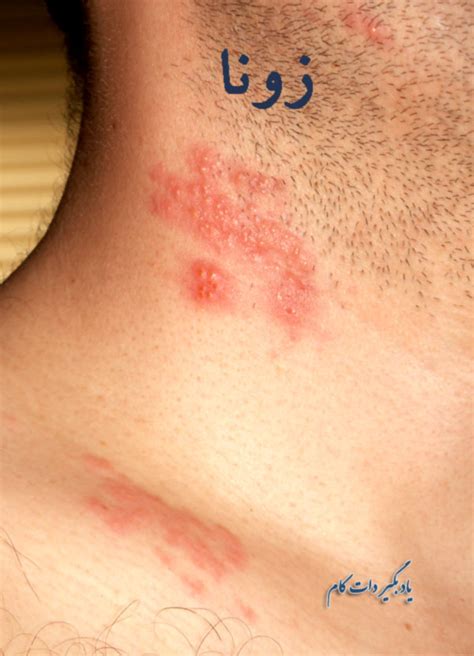 بیماری زونا، علایم، راههای تشخیص، درمان و پیشگیری یادبگیر