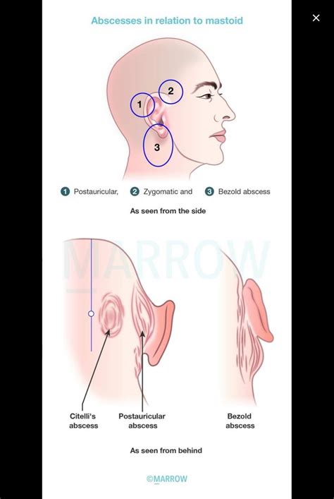 Sites Of Abscess In Relation To Mastoid In 2025 Ear Diseases Body Ache Otitis
