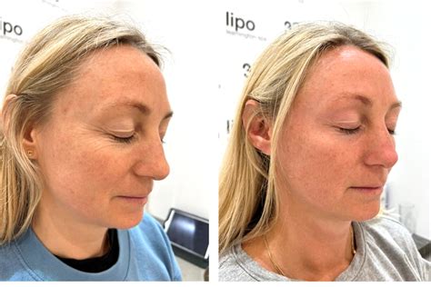 3d Dermaforce Microneedling Radiofrequency 3d Aesthetics Knowle