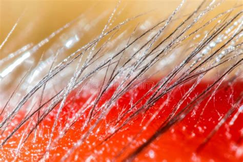 Examining The Girl S Face Closely One Can Observe Couperose Red And Dilated Capillaries