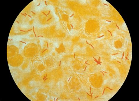 Bolesti Pluća Tuberkuloza Simptomi Uzroci I Liječenje Hr