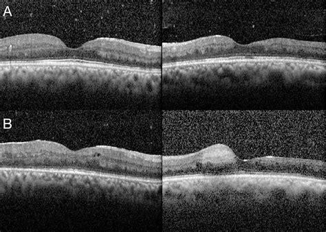 Syphilitic Retinal Vascular Disease Retinal Physician