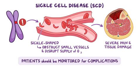 Sickle Cell Disease Video And Meaning Osmosis
