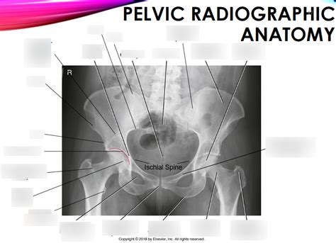 Ap Pelvis Xray Diagram Quizlet