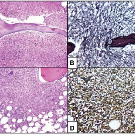 Patterns Of Marrow Involvement In Hl A B Diffuse Pattern A