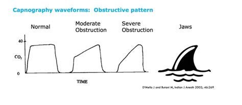 The Capnography Detective Mastering End Tidal Co2 Monitoring
