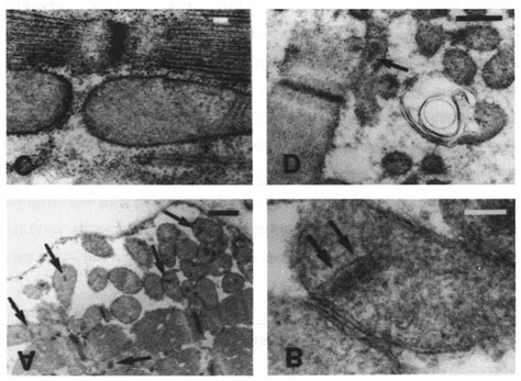 Abnormal Mitochondria In Vastus Lateralis Muscle A Many Mitochondria