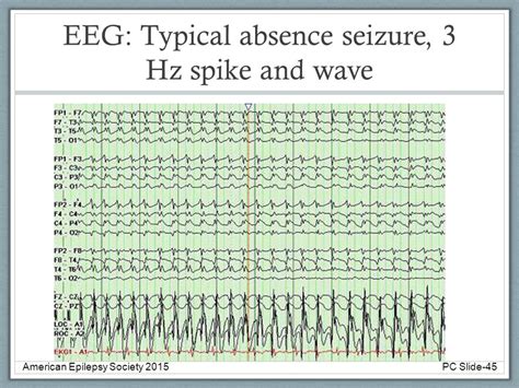 Pediatric Epilepsy Slide Deck American Epilepsy Society Ppt Download