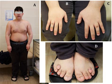 Figure 3 From A Novel Gnas Mutation In A Patient With Ia