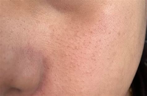 Routine Help Need Help With Stubborn Bumps On Cheeks R