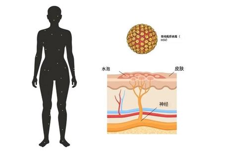 遭受生殖器疱疹困扰，应如何应对？ 知乎