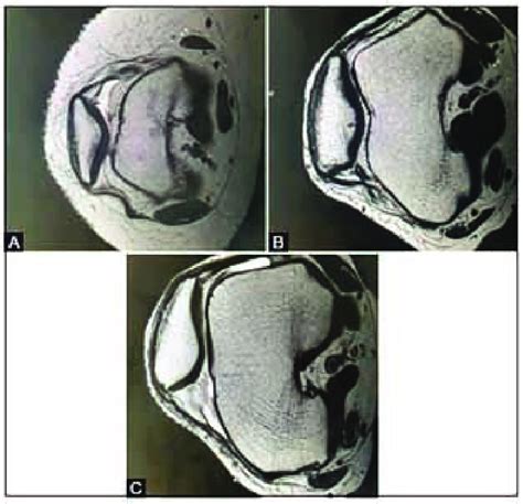 A Mri Axial Images Assessing Types Of Patellar Morphology Based On