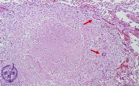 5lung Pleura 11 Pulmonary Tuberculosispathology Core Pictures
