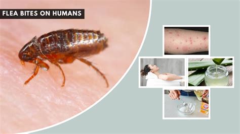 Flea Bites On Humans Symptoms Treatment Pictures