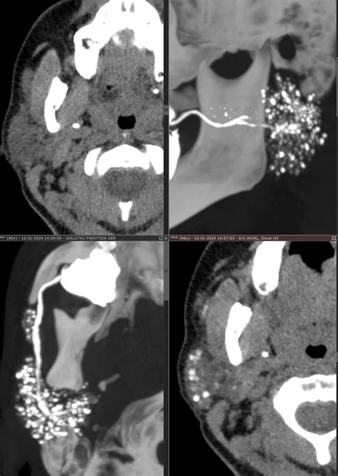 Ilson Sepulveda A Bds Msc On Linkedin Ct Sialogram Ct Head Sw Wo Contrast Mip After