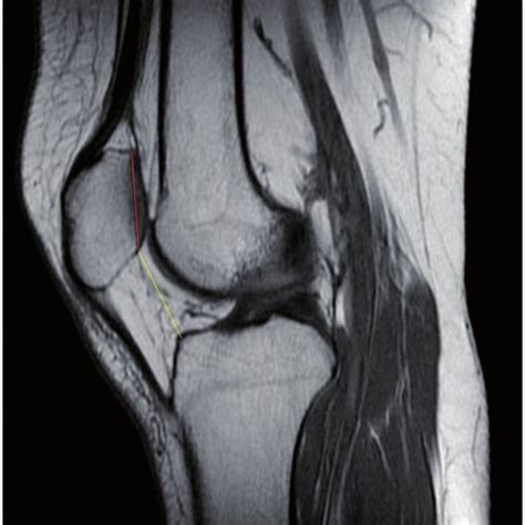 Diagnostic Value Of Patellar Malalignment Measurements Download