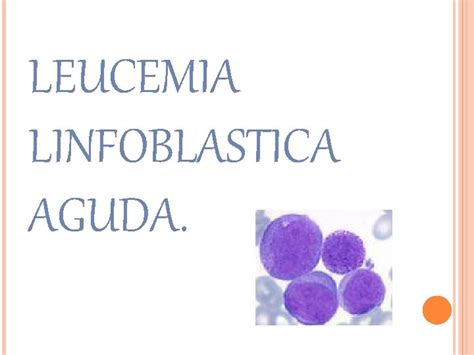 Leucemia Linfoblastica Aguda La Leucemia Es Un Grupo