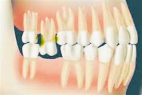 What Are Supraerupted Teeth Causes Treatment And All