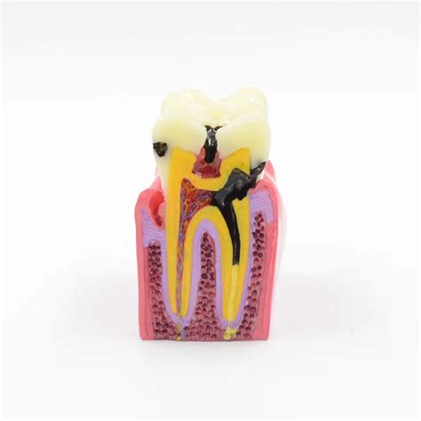 Dental Caries Nursing Model An Enlarged Anatomical Model Of Dental