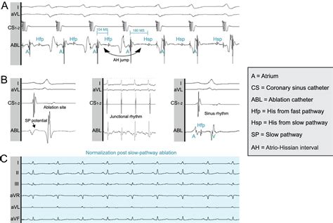 Manifest And Concealed Atrioventricular Nodal Double Firing Revista