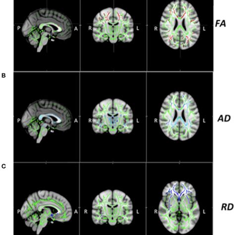 A C White Matter Diffusion Tensor Mri Findings In Patients With