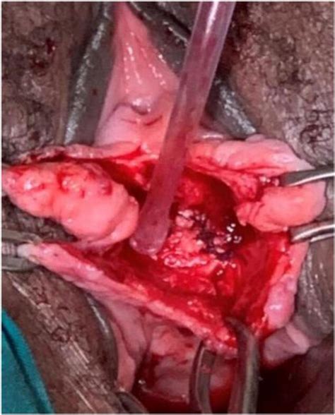 Urethral Fistula Repair Including Urethral Elongation And An Anti