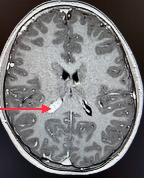 Spin Academics On Linkedin Tip Of The Day 💡 An Enlarged Choroid Plexus Is A Feature Of Sturge Spin Academics On Linkedin Tip Of The Day 💡 An Enlarged Choroid Plexus Is A Feature Of Sturge