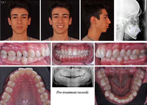 Aesthetic Orthodontic Treatment With F22 Aligners A Class Ii