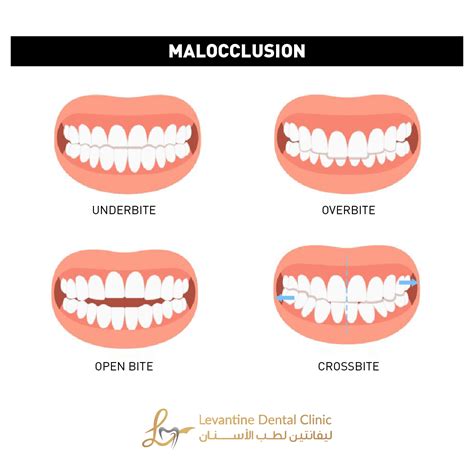 Can Braces Help With Jaw Alignment Problems