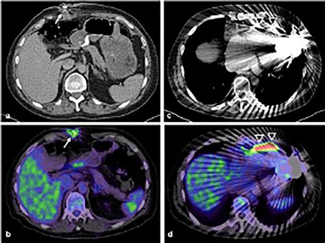 Lvad Driveline Infection With Intrathoracic Extension A Ct Image Shows