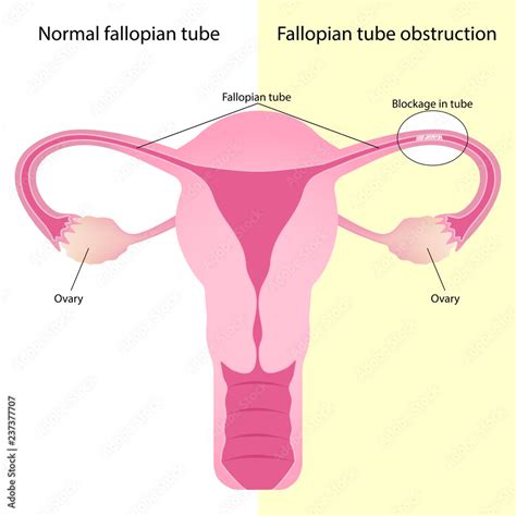 How Much Does A Uterus Fallopian Tubes And Cervix Weigh At Susan