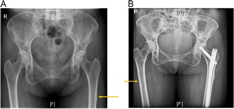 A Radiology Of Pelvis Displaying Cortical Thickening And Beaking Of